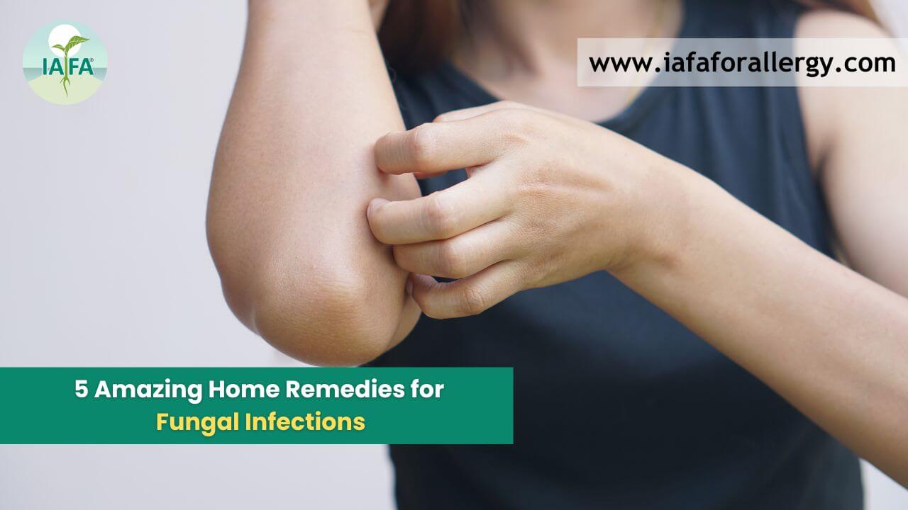 5 Amazing Home Remedies for Fungal Infections