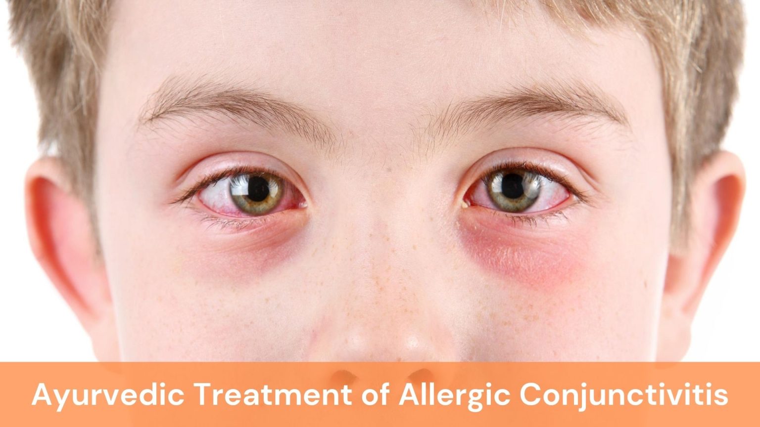Allergic Conjunctivitis - Causes, Symptoms and Ayurvedic Treatment