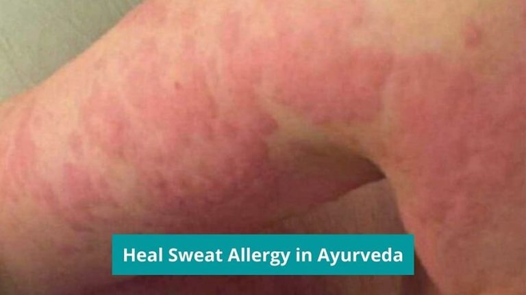 How to Heal Sweat Allergy in Ayurveda?