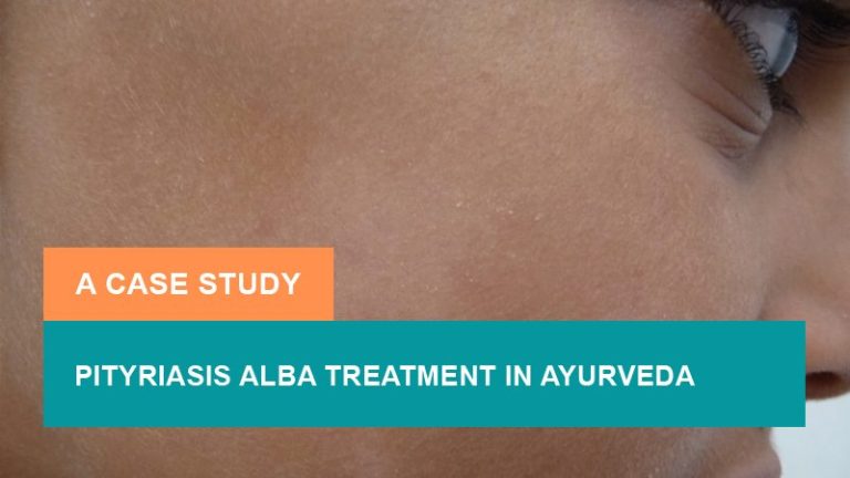 23-Year-Old Female Patient Recovered from Pityriasis Alba - A Case Study