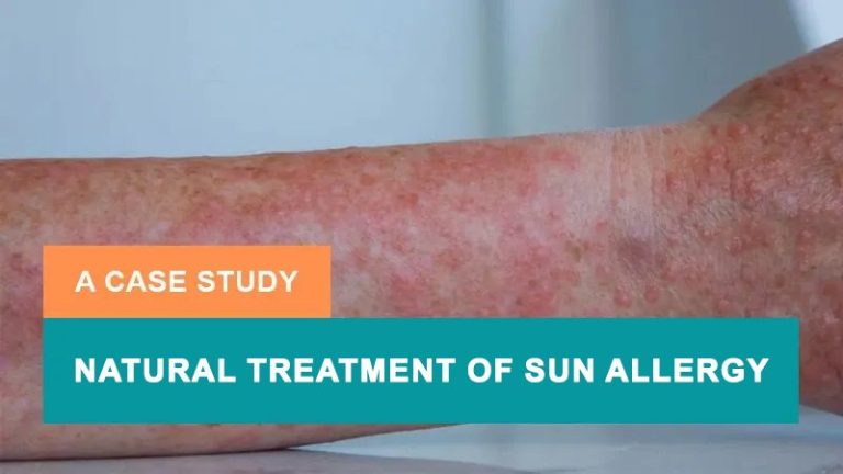 31-Year-Old Female Patient Recovered from Sun Allergy - A Case Study