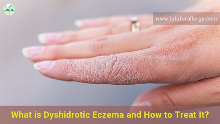 What is Dyshidrotic Eczema and How to Treat It?