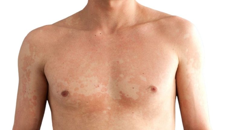 How Do You Get Rid of Tinea Versicolor Permanently?