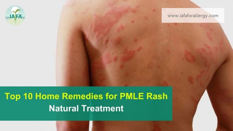 Top 10 Home Remedies for PMLE Rash – Natural Treatment